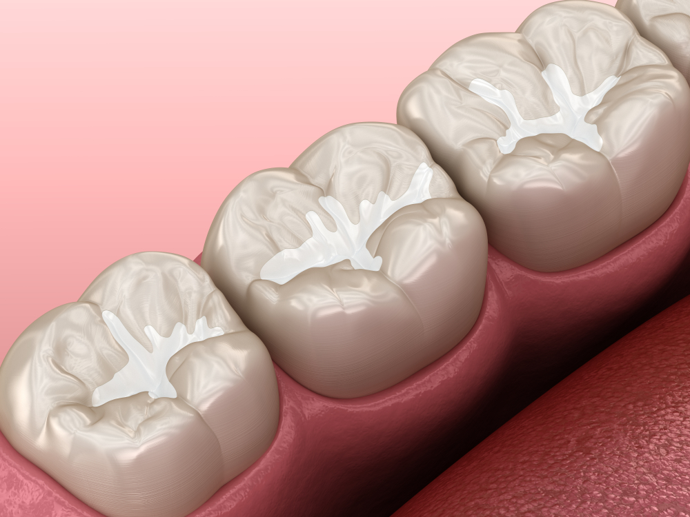 What is a Dental Filling, Types of Dental Fillings, and How Much Do ...